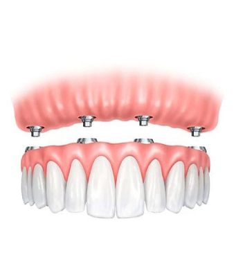 Implantes dentales - en Concepción | Biosur Dental